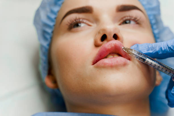Lip Filler Bruising: A Comprehensive Guide on Healing & Recovery